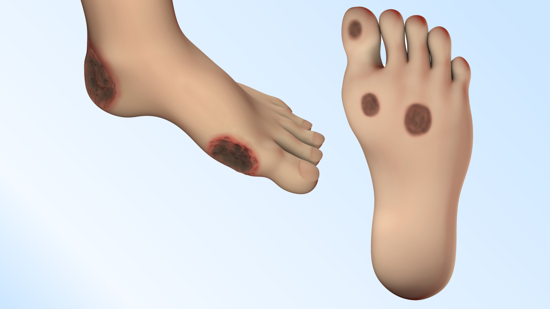 Venous Leg Ulcers | Arterial vs Venous. How to Treat Them?